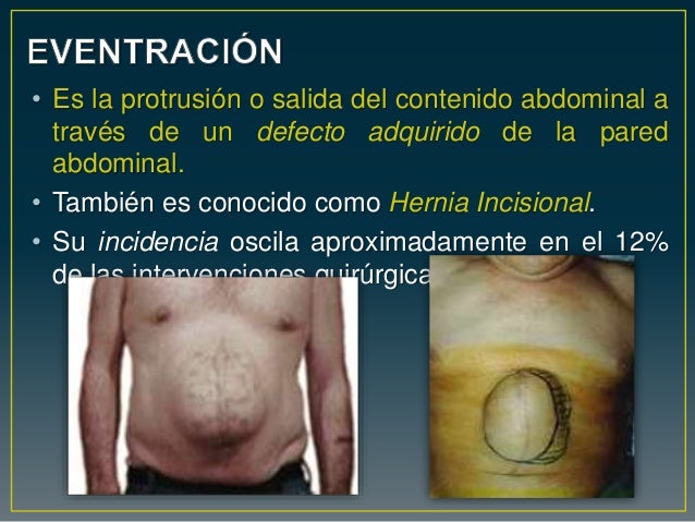Práctica Médica II - Hernias y Eventraciones