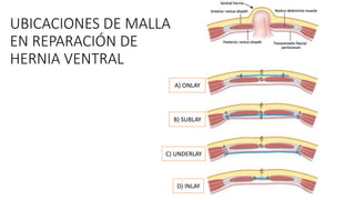 HERNIAS Y EVENTRACIONES, medicina humana.pptx