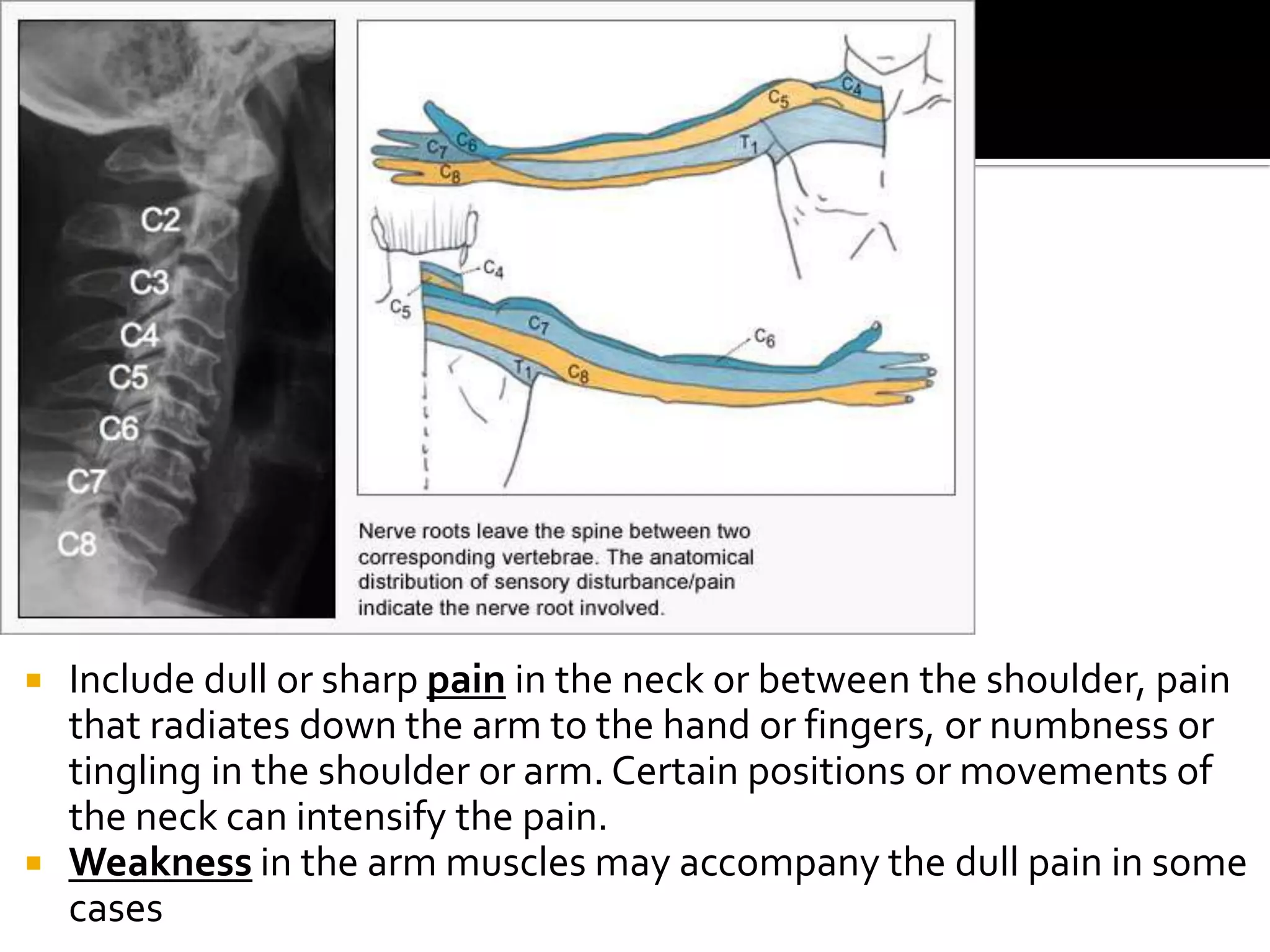 Herniated cervical disc | PPTX