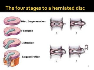 Herniated cervical disc | PPTX