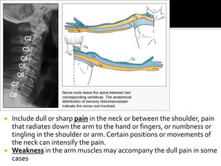 Herniated cervical disc | PPTX