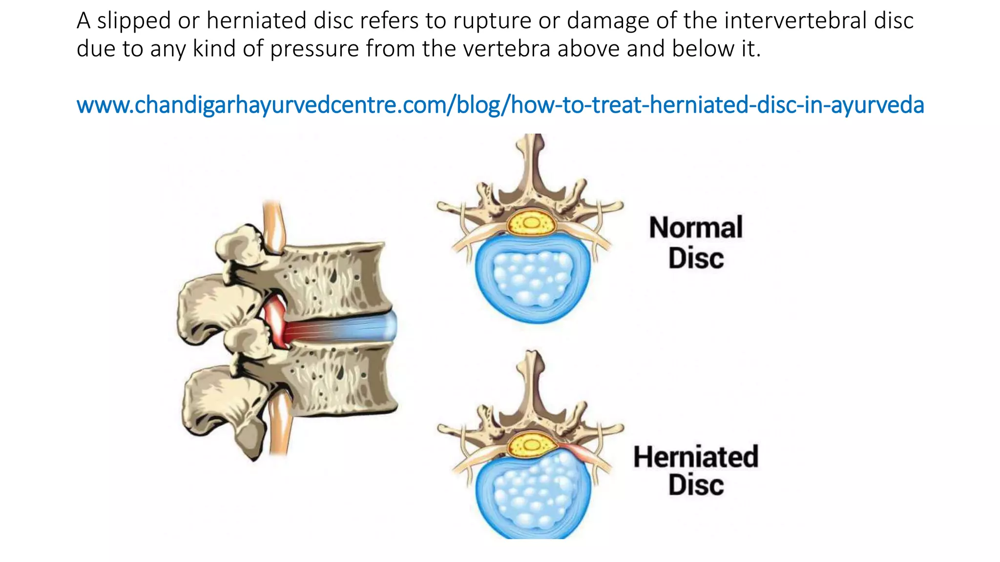 Ayurvedic Treatment for Herniated Disc | PPTX