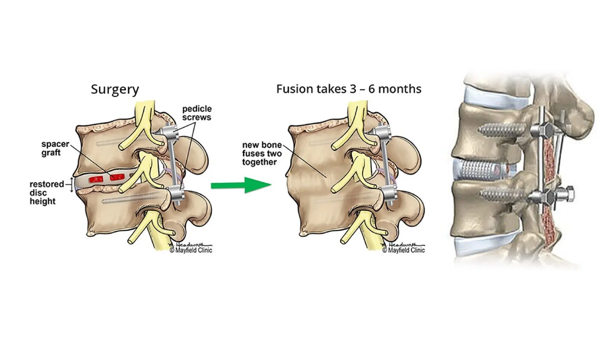 Herniated Disc Surgery Gowtham 303 Pdf
