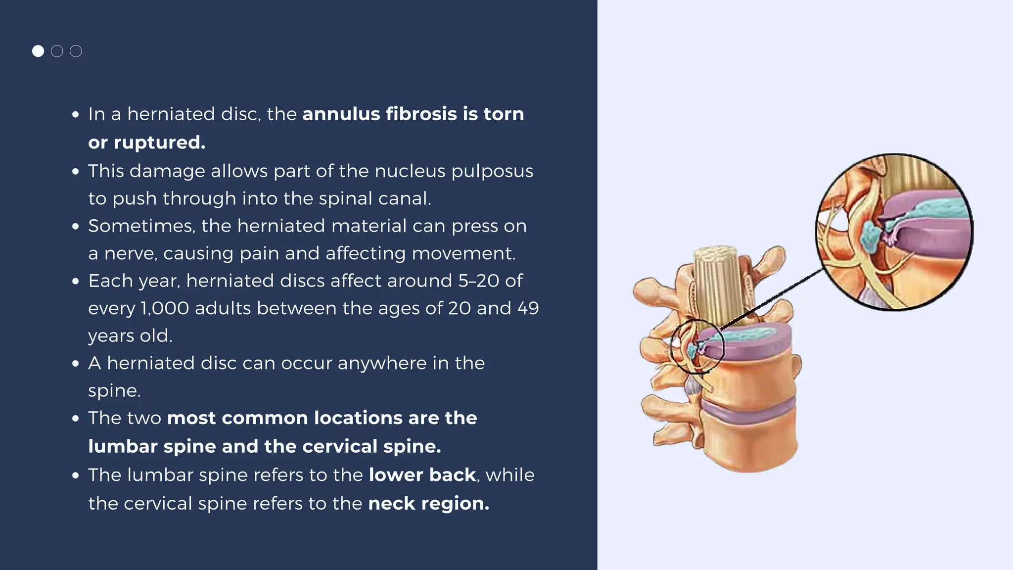 Herniated Disc Surgery( Gowtham 303).pdf