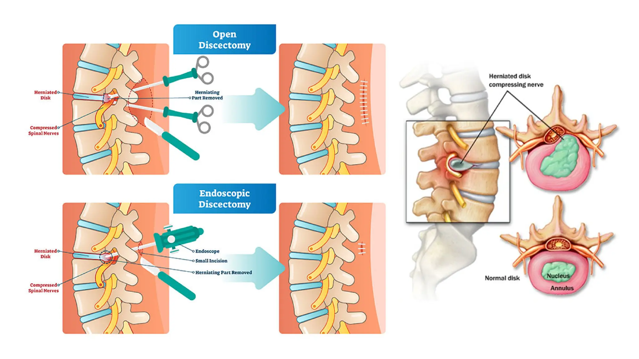 Herniated Disc Surgery( Gowtham 303).pdf