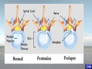 Herniated intervertebral disc2 | PPTX
