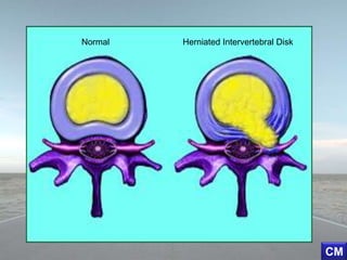 Herniated intervertebral disc2 | PPTX