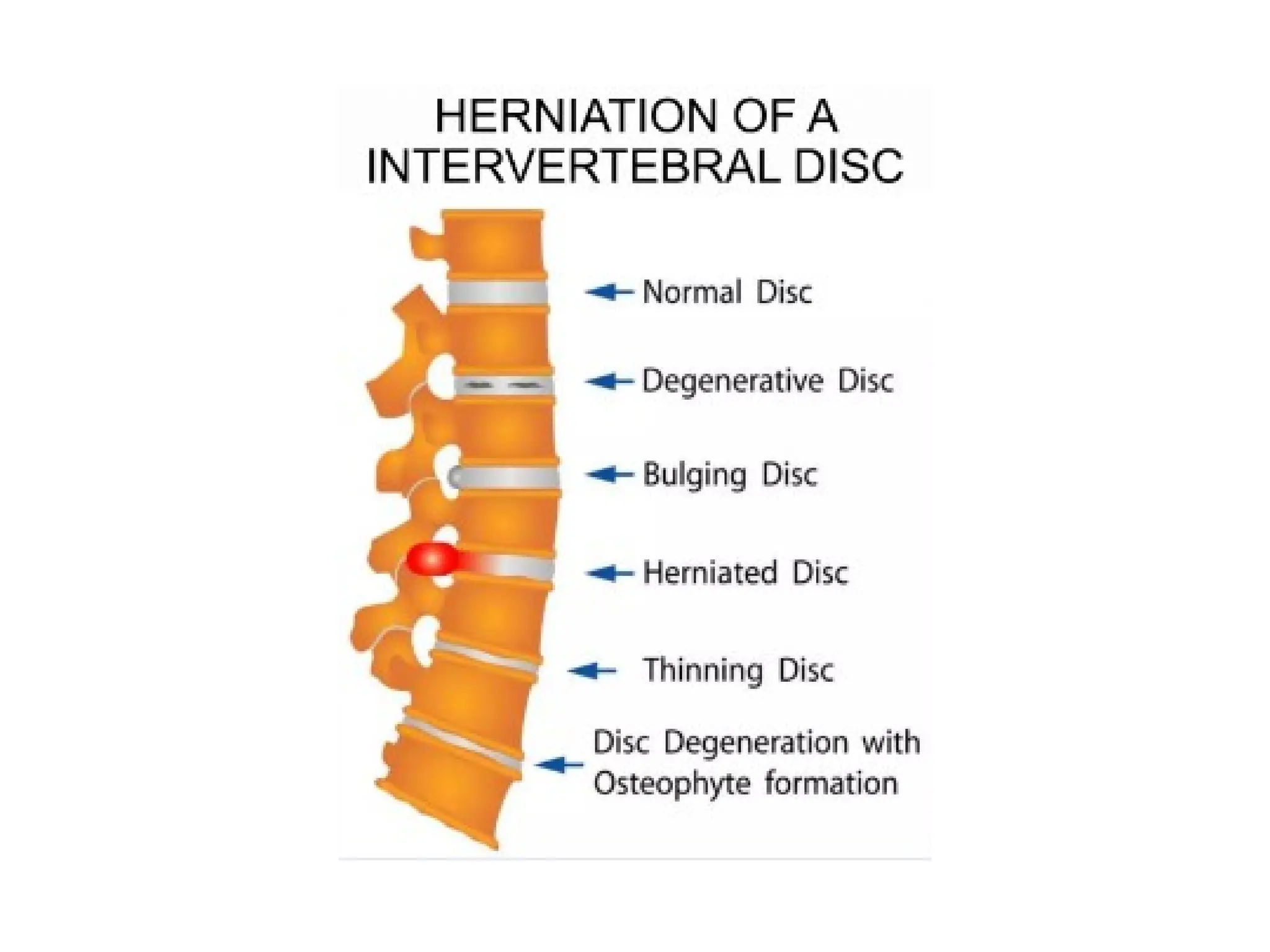 Herniation of a Intervertebral Disc, Unit-VI.pptx