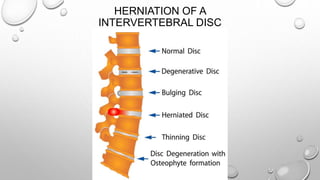 Intervertebral Disc Herniation