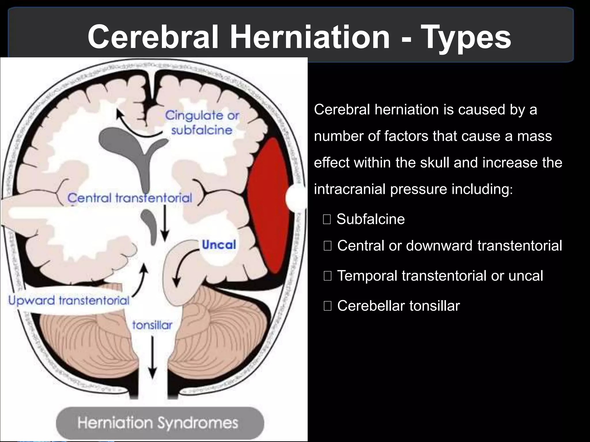 Herniation Syndromes | PPTX