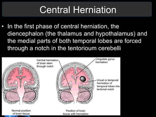 Herniation Syndromes | PPT