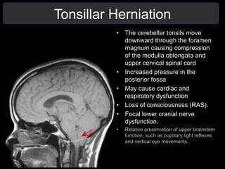 Tonsillar Herniation