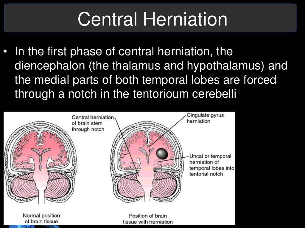 Herniation Syndromes