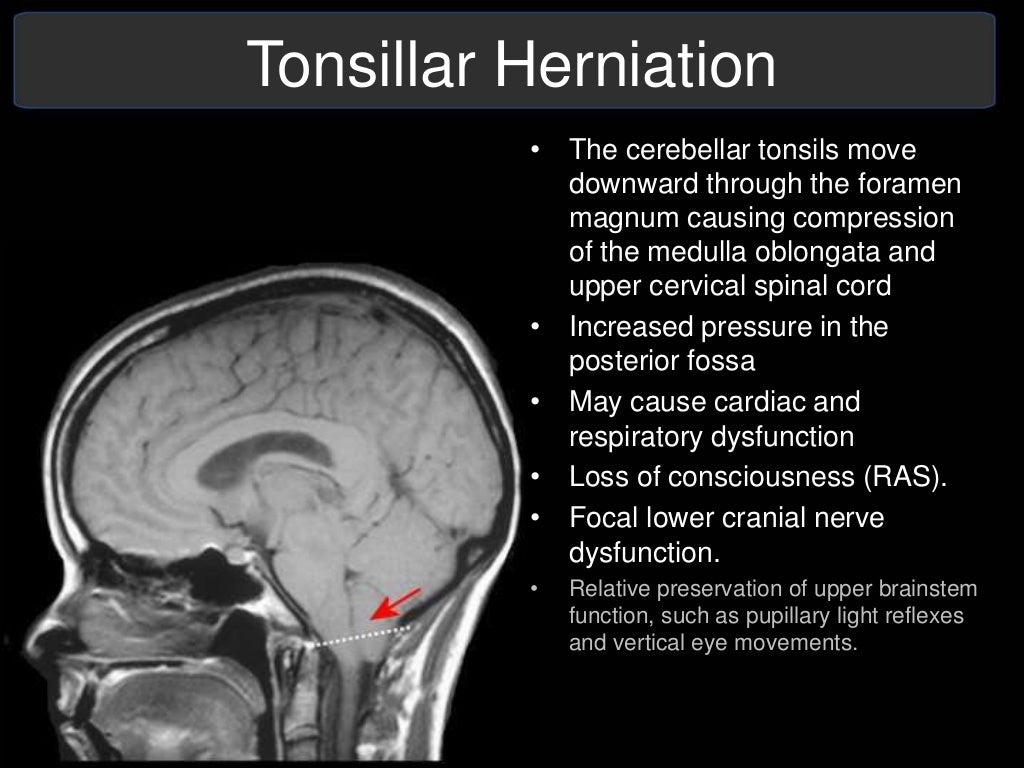 Herniation Syndromes