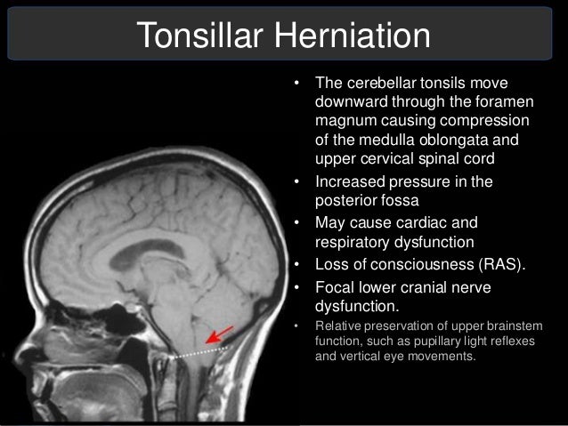 Herniation Syndromes