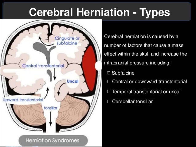 Herniation Syndromes