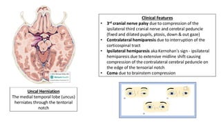 Herniation Syndromes - Neuro Imaging Master Series | PDF