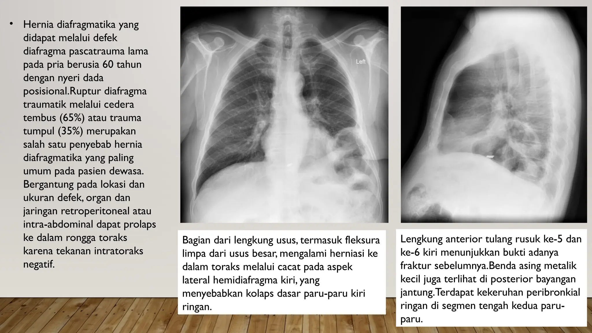 Hernia tulang rusuk pasca trauma/kecelakaanpptx | PPTX