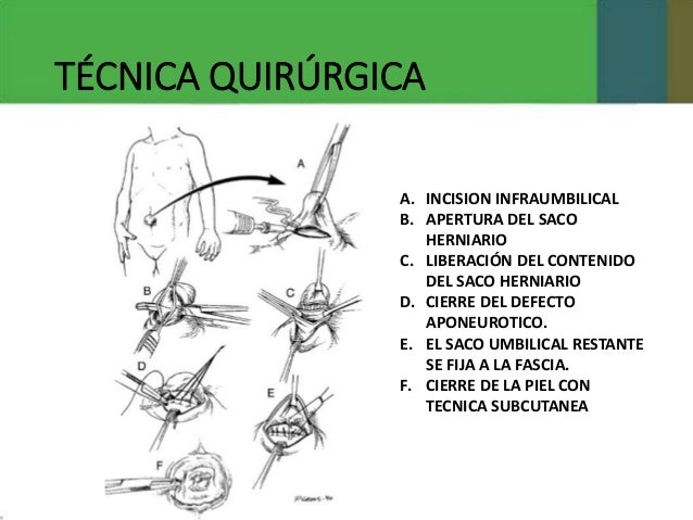 Umbilical Hernia Anatomy