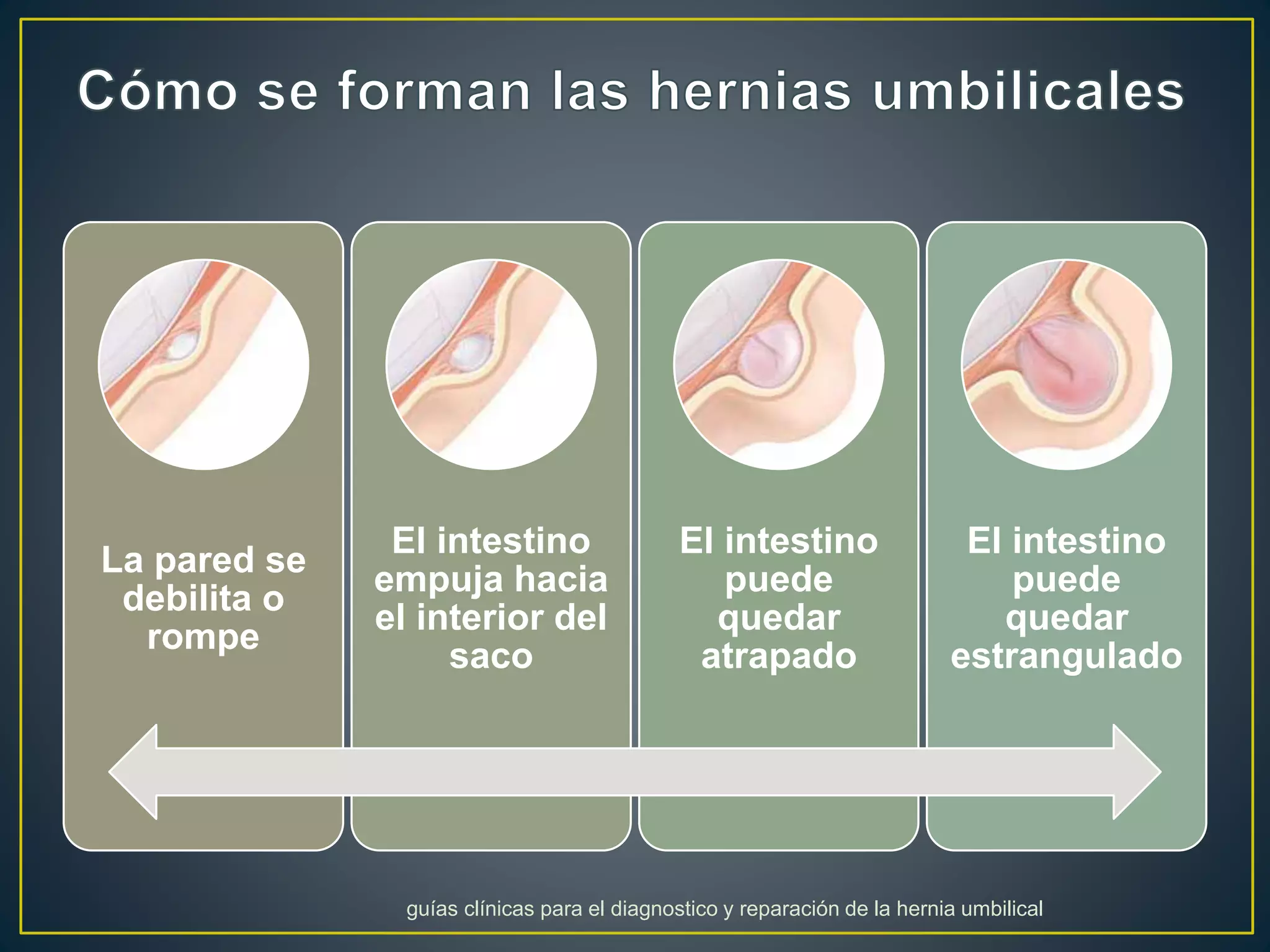 Hernia umbilical | PPTX
