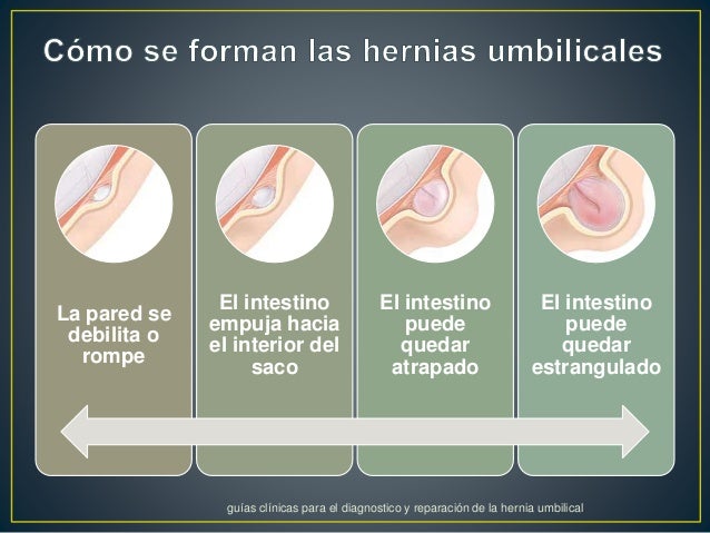 Hernia umbilical