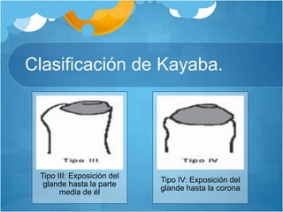 Hernia umbilical, Fimosis y Parafimosis | PPTX