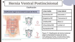 Hernia Ventral Postinsicional.pptx