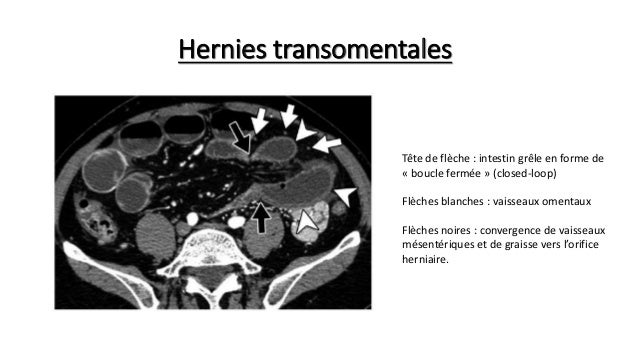 Hernies internes