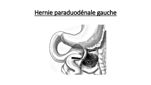 Hernies internes : types, diagnostic et traitements