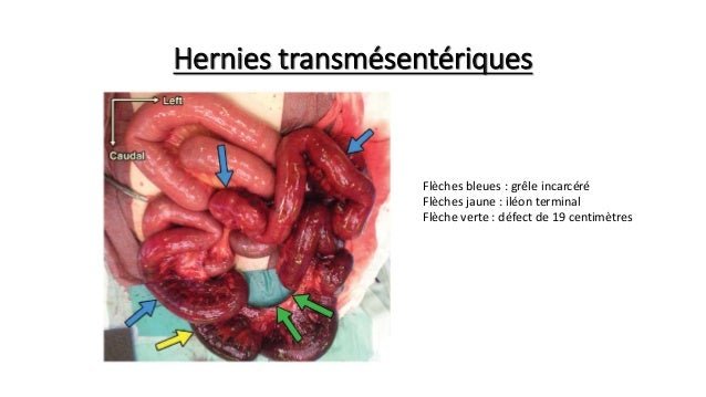 Hernies internes : types, diagnostic et traitements