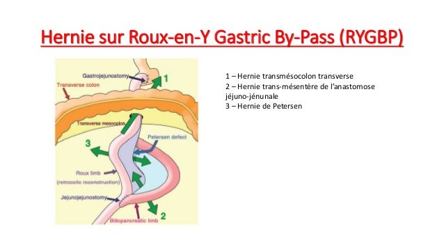 Hernies internes : types, diagnostic et traitements