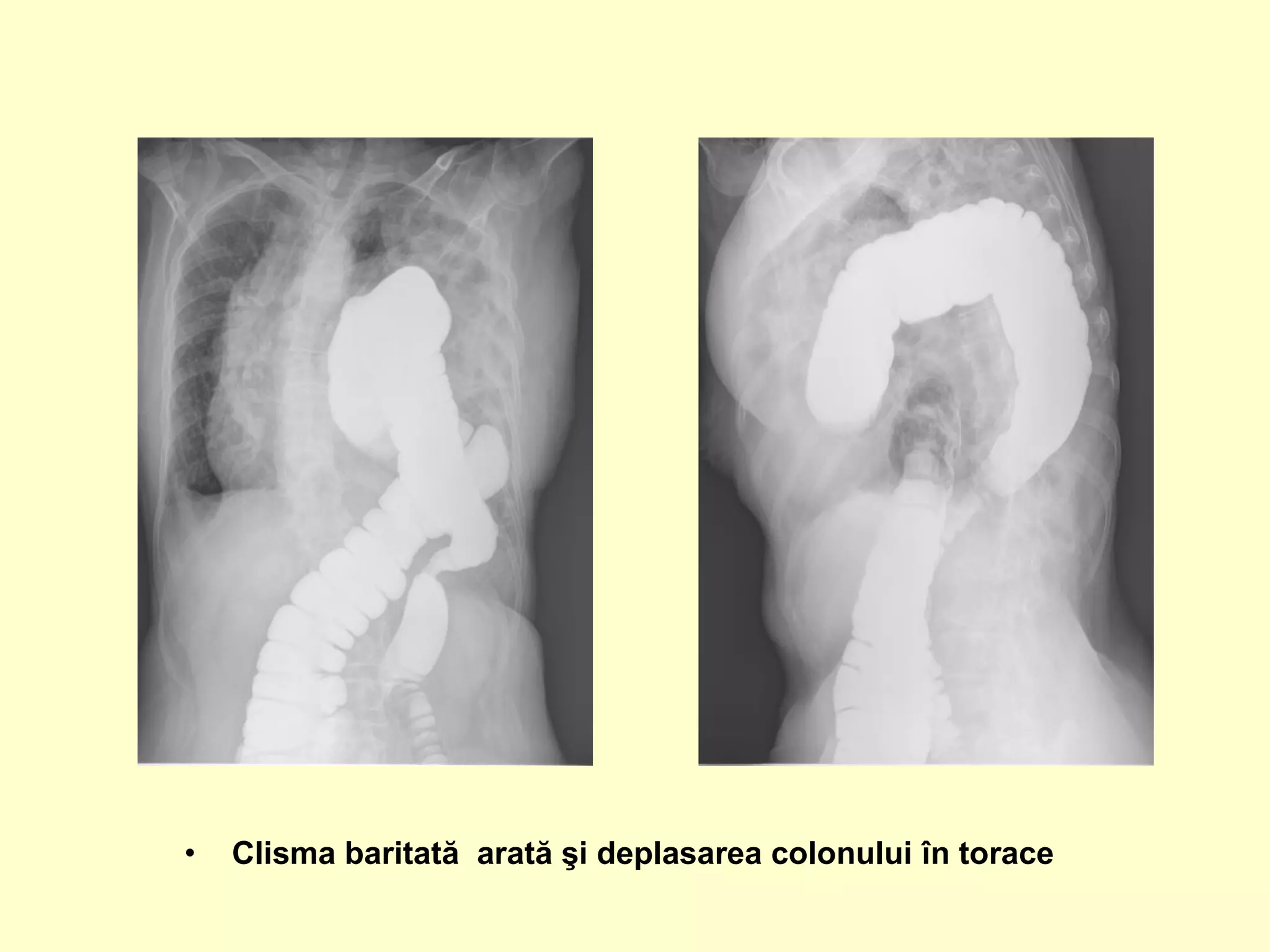 Hernii diafragmatice | PPT
