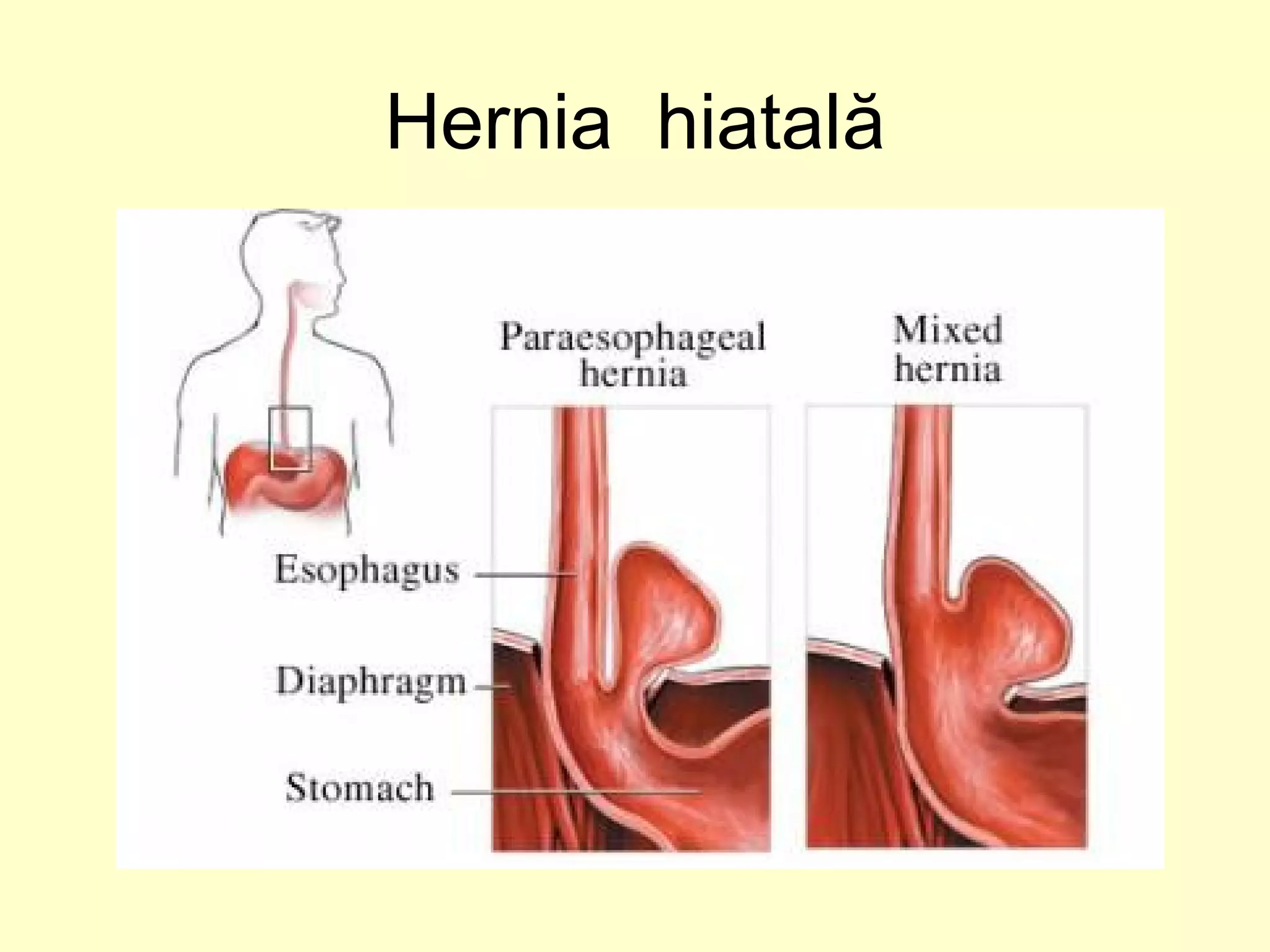 Hernii diafragmatice | PPT