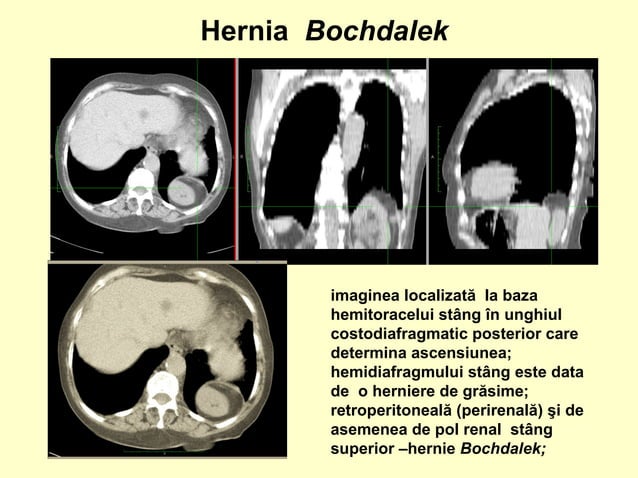 Hernii diafragmatice | PPT