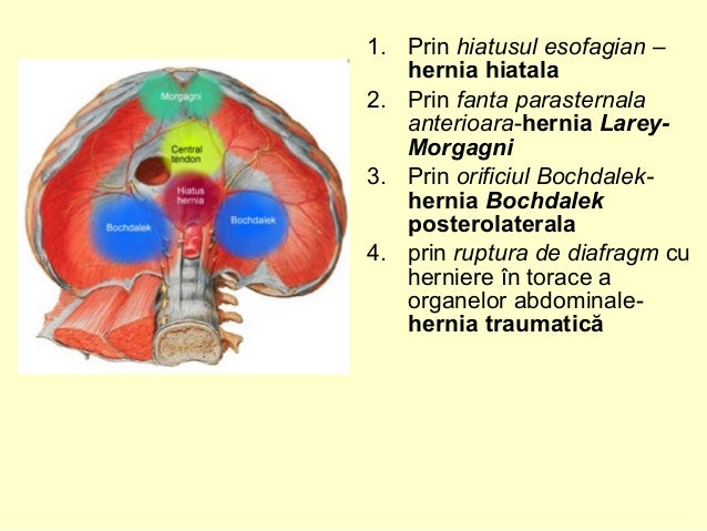 Hernii diafragmatice