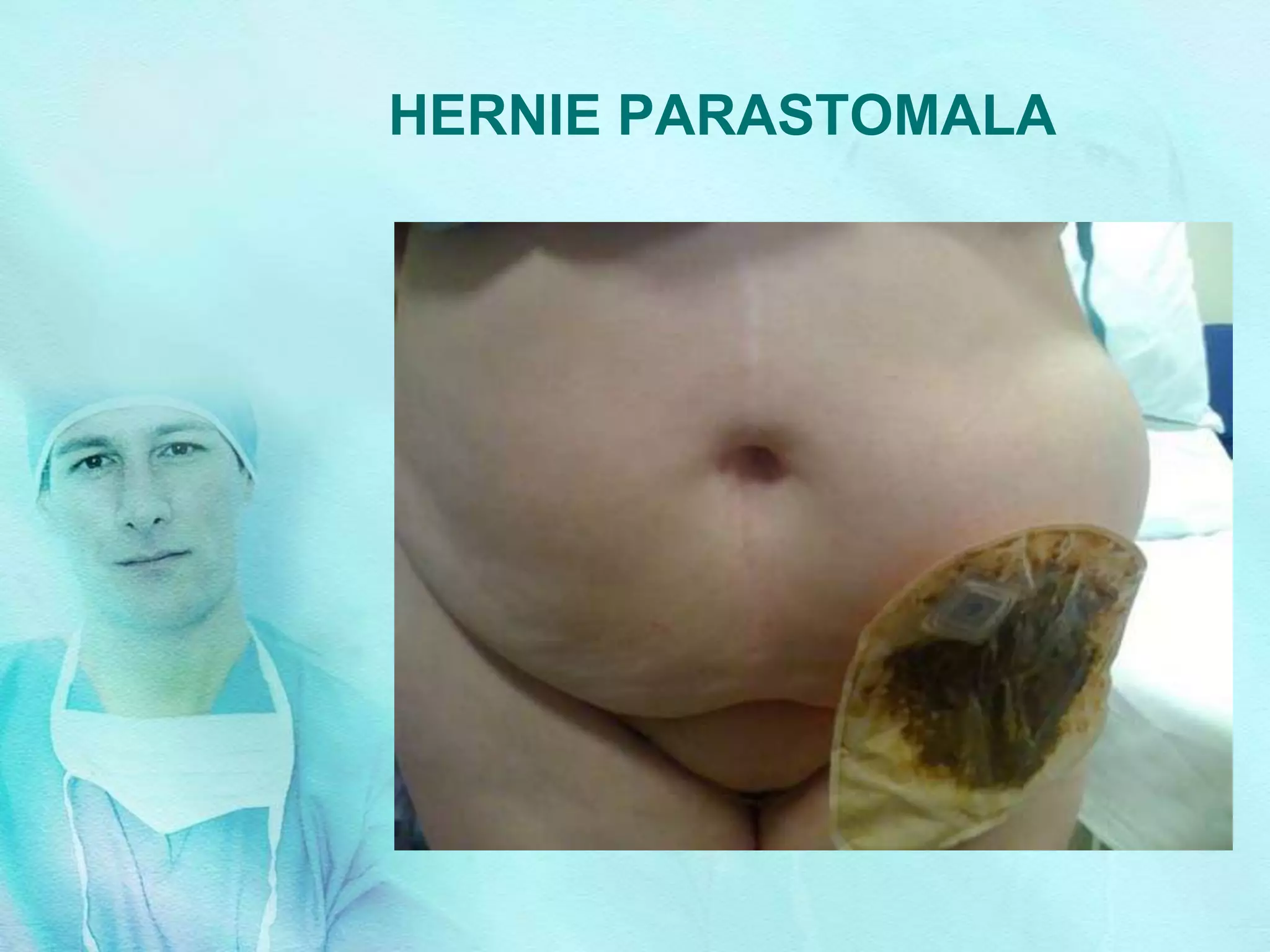 Hernii parastomale | PPT