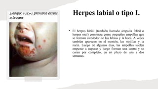 herpes neonatal para paciente pediatrico | PPTX