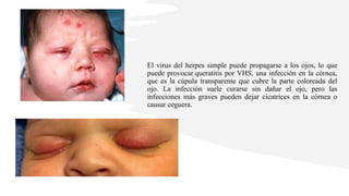 herpes neonatal para paciente pediatrico | PPTX