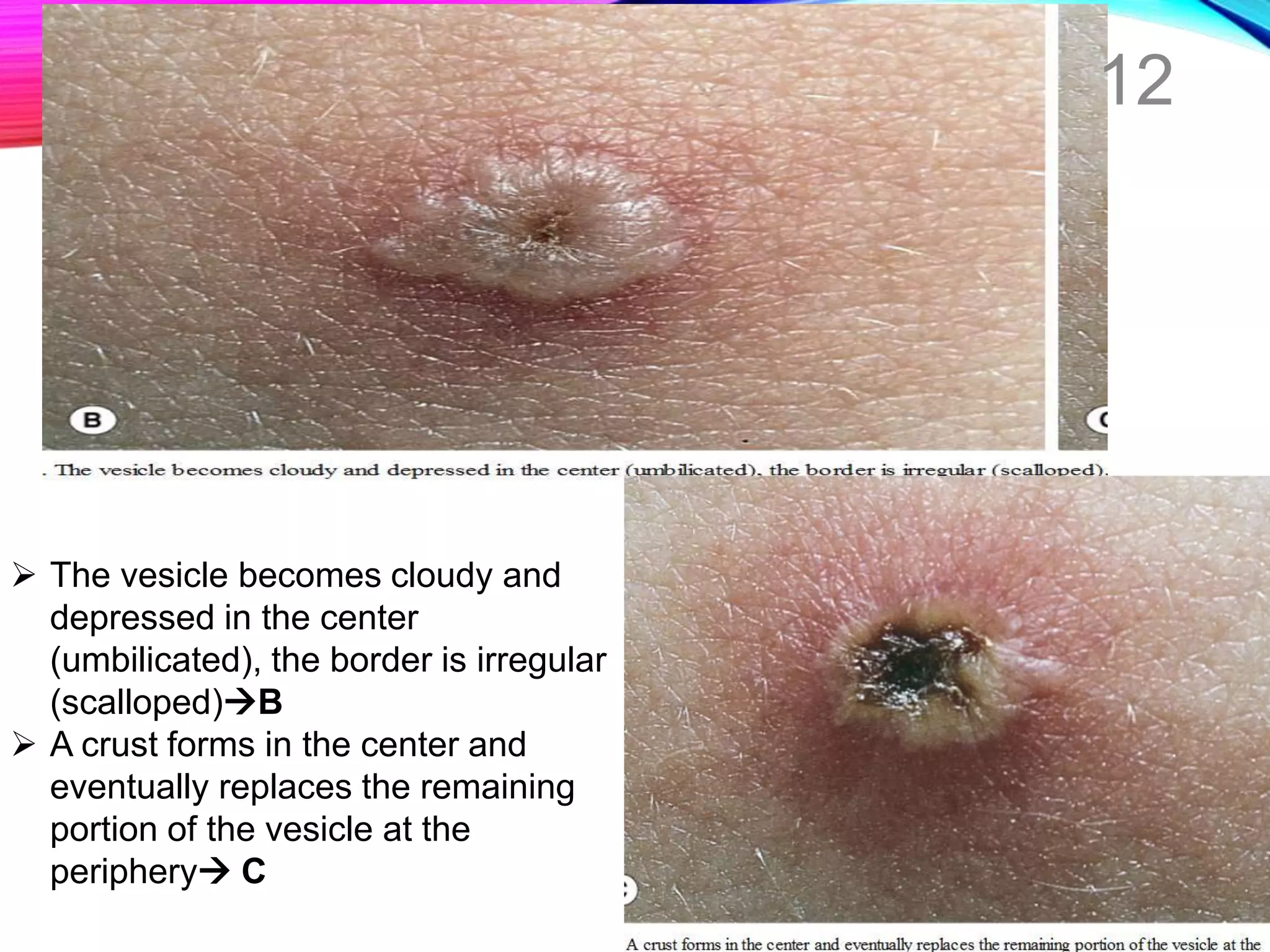 Chicken Pox (Varicella) & Herpes Zoster | PPTX
