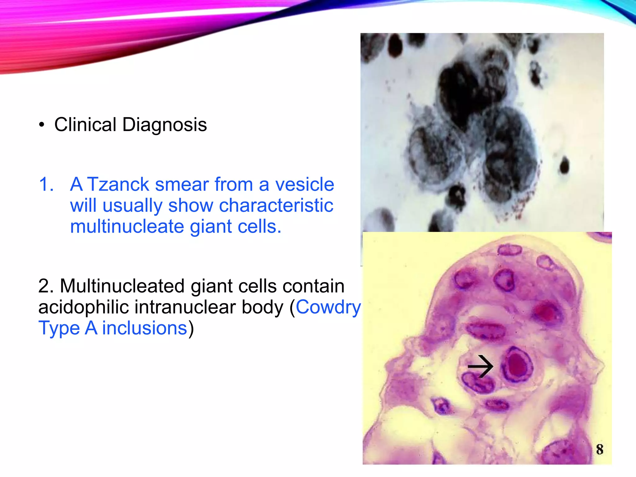 Chicken Pox (Varicella) & Herpes Zoster | PPTX