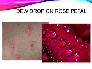 Chicken Pox (Varicella) & Herpes Zoster | PPTX