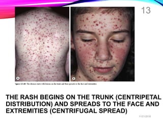 Chicken Pox (Varicella) & Herpes Zoster | PPTX