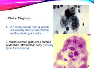 Tzanck Smear Varicella