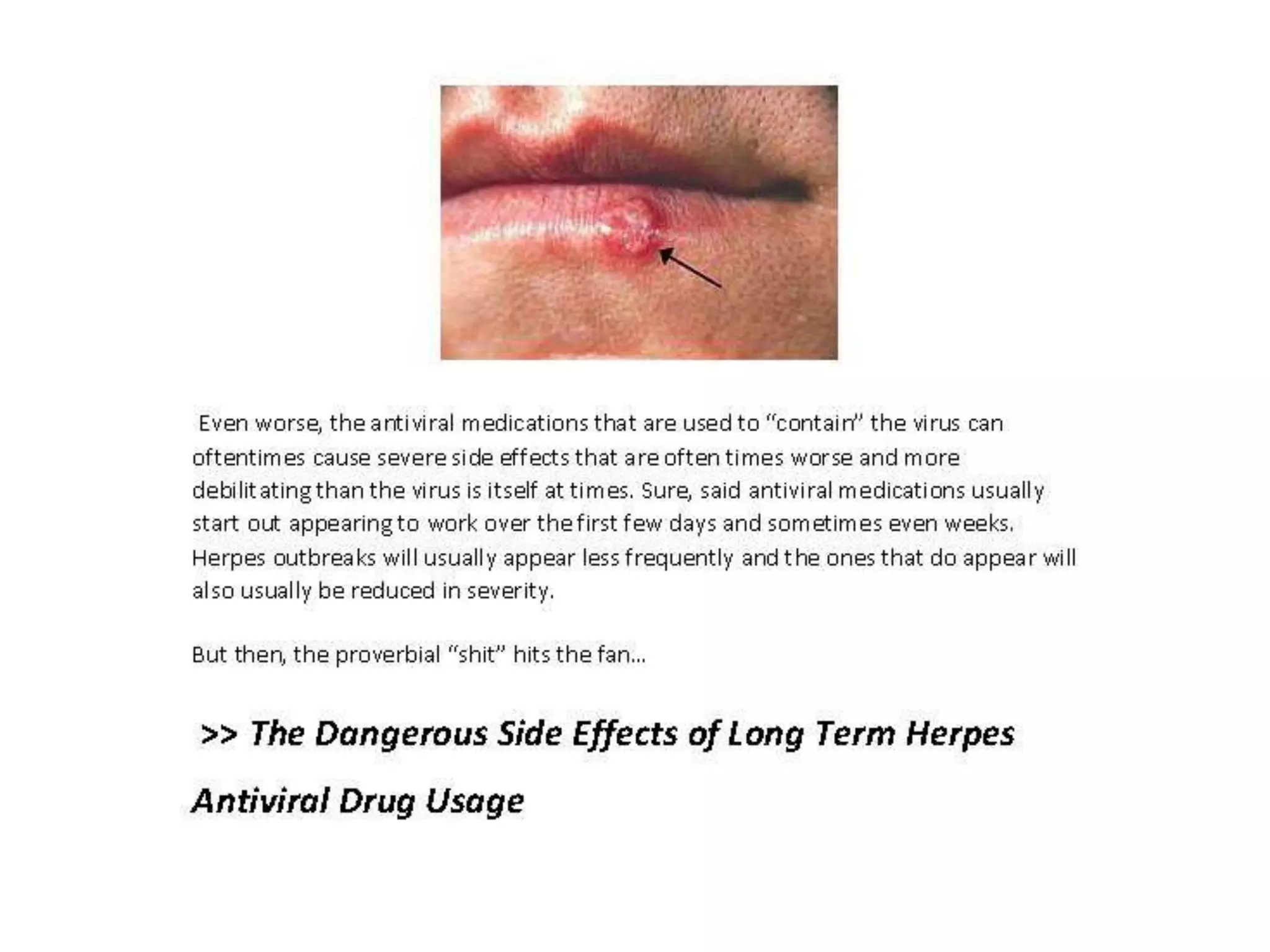 Herpes 1 Cure | PPTX