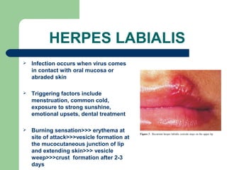 Herpes simplex | PPT