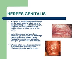 Herpes simplex | PPT