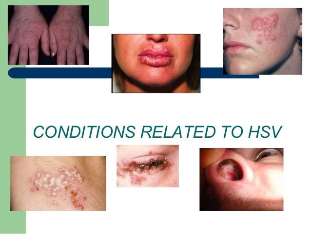 Herpes simplex