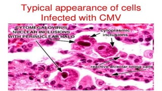 Herpes and cmv | PPT