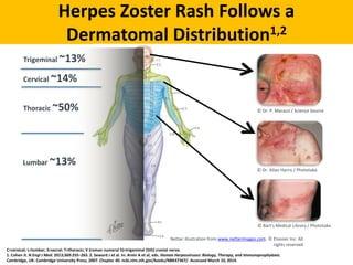 ABC OF PREVENTION OF HERPES ZOSTER IN ADULT WOMEN DR. Sharda Jain | PPTX