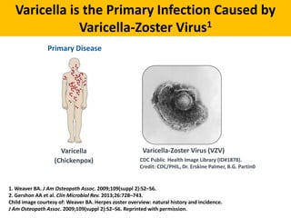 ABC OF PREVENTION OF HERPES ZOSTER IN ADULT WOMEN DR. Sharda Jain | PPTX